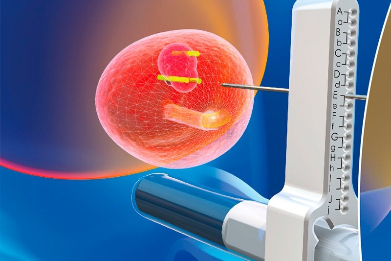 BIOPSIA DE PROSTATA - Urología San Gerónimo - Santa Fe (capital)