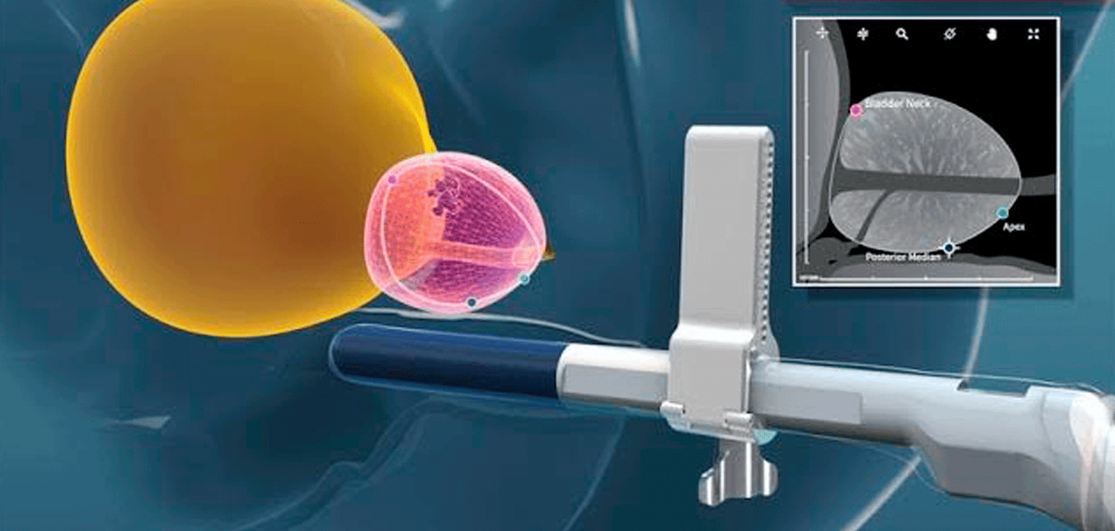BIOPSIA DE PROSTATA - Urología San Gerónimo - Santa Fe (capital)